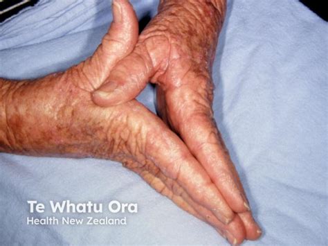 Keratoelastoidosis Marginalis