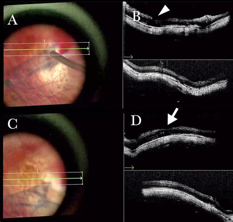 A Microscope View Of The Macular Area In Case Of Myopic Traction Download Scientific Diagram