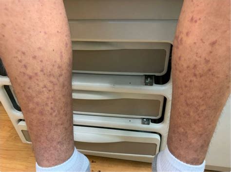 Hypocomplementemic Urticarial Vasculitis