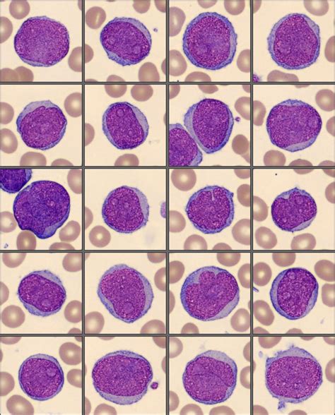 Patient Case 8 Mantle Cell Lymphoma Cellavision