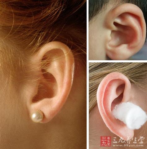 耳瘘手术后图片 动静脉内瘘示意图 动静脉内瘘 第5页 大山谷图库