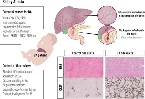 Biliary Atresia Diagnose Medizzy