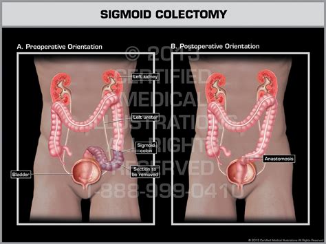 Sigmoid Colectomy