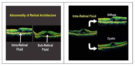 What Is Optical Coherence Tomography Oct Basic Interpretation