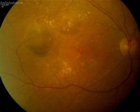 Idiopathic Polypoidal Choroidal Vasculopathy