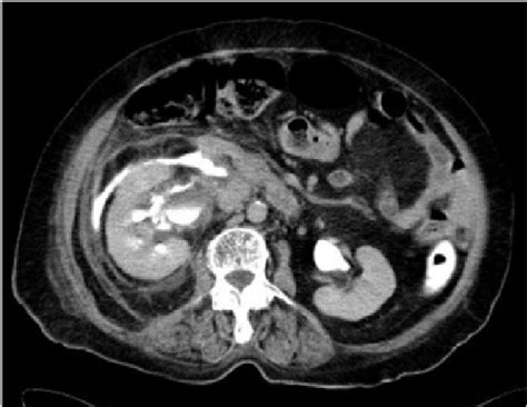 Delayed Phase Of Contrast Enhanced Ct Scanning That Revealed