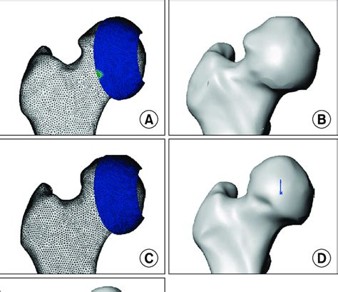 A B Preoperative Finite Element Model Of A Patient In Group B A