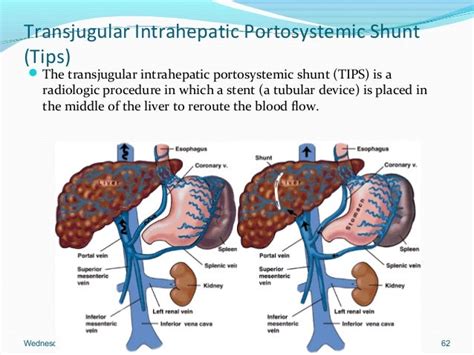 Liver Cirrhosis 2018