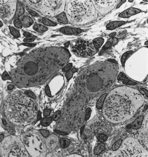 Differentiation Of The Ovary Clinical Tree
