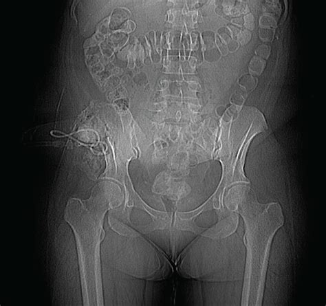 Ct Scanogram Of The Patients Abdomen And Pelvis A And Ct Scan Axial Download Scientific
