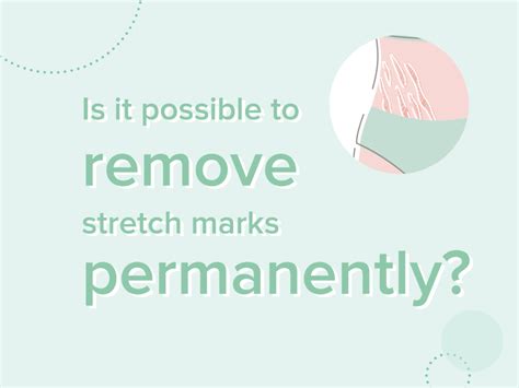 Community Asks The Science Behind Stretch Marks In Sync By Nua