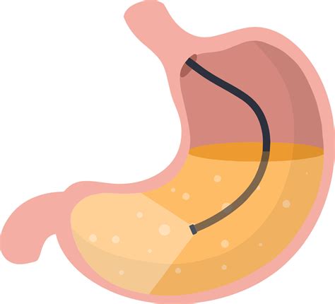 Gastroscopy Endoscopy And Digestive Problems Hose With Camera
