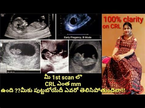 How To Know The Gender Of The Baby With CRL In Mm Baby Babe Symptoms CRL Standards YouTube