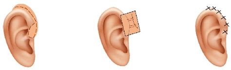 Figure 3 From Surgical Management Of Preauricular Fistula Based On