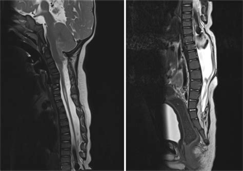 Post Operative Mri Showing Type 2 Chiari Malformation And Spinal Cord