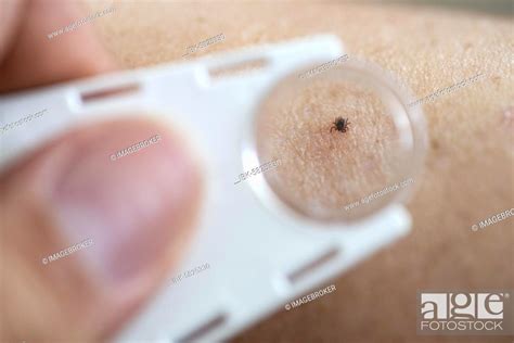 Castor Bean Tick Ixodes Ricinus Tick View Through Magnifying Glass