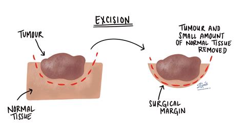 Excision MyPathologyReport