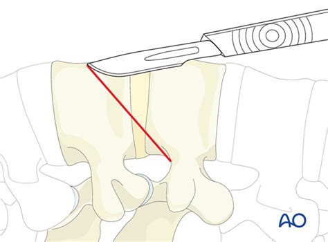 Minimally Invasive Transpsoas Approach L2 L4
