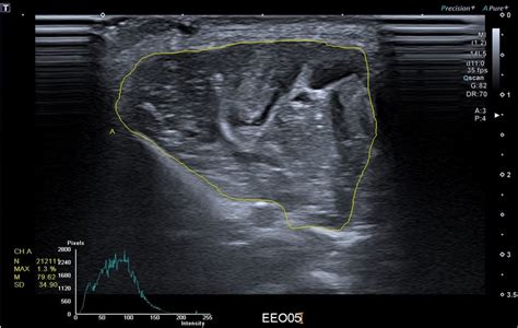 B Mode Image For Calculating Echogenicity With The Freehand Trace Of Download Scientific