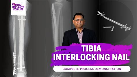 Tibia Interlocking Nail Complete Procedure Youtube