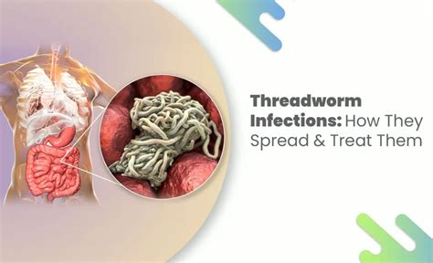 Threadworm Infections How They Spread And Best Ways To Treat Them