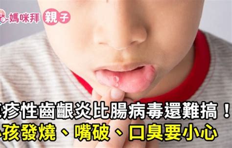 疱疹性齒齦炎比腸病毒還難搞！小孩發燒、嘴破、口臭要小心｜mamibuy編輯部 防疫專區