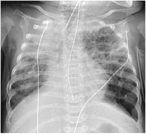 Chest Radiograph Demonstrating Widespread Coarse Interstitial Markings