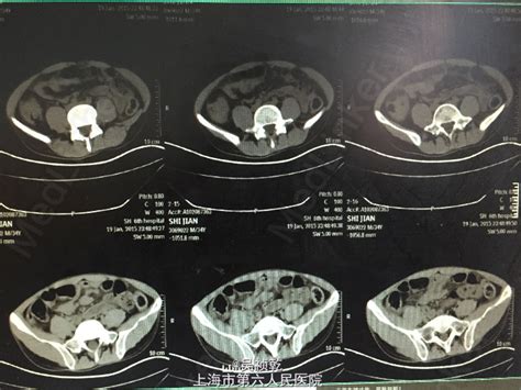 罕见的克罗恩病小肠穿孔
