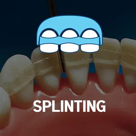 Splinting Alluxdentalcare