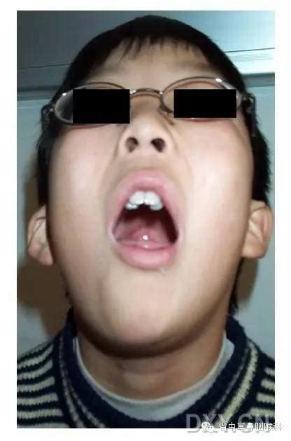 儿童鼾症手术 鼾症图片 儿童 大山谷图库