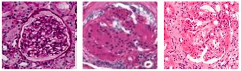 Normal Glomerulus