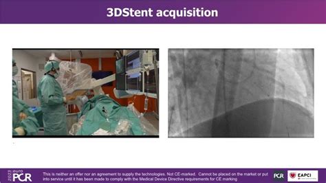 3dstent A New Era In Stent Enhancement
