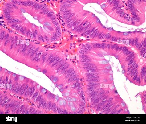 Tubular Colon Polyp Light Micrograph This Specimen Shows Tissue From