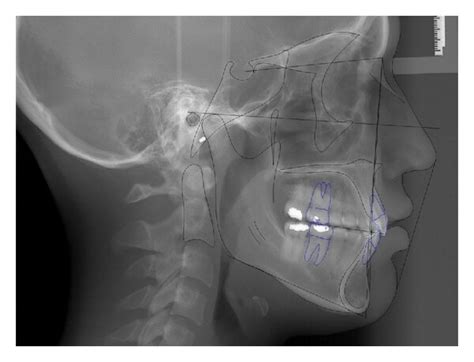 Final Lateral Cephalometric Radiograph Download Scientific Diagram