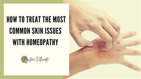 Homeopathy For Itchy Skin And Hives Cristina Villacorta