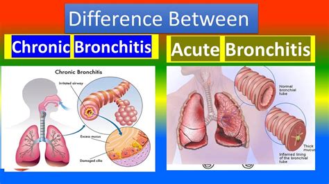 Acute Bronchitis Vs Copd At Jocelyn Wilson Blog
