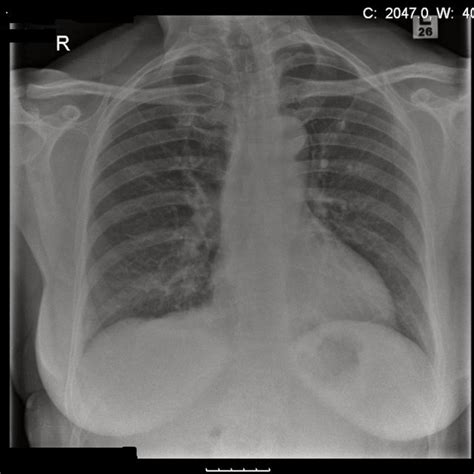 Cxr On Presentation With Pe Download Scientific Diagram