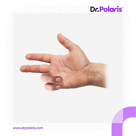Dr Polaris The Deformity Shown In The Image Is Seen In Facebook