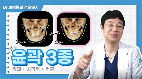 수술일지 얼굴 보정 필요없는 윤곽3종 안면윤곽 수술 전후🦒 기린성형외과 Youtube