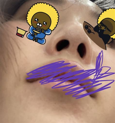 의사에게 물어보세요 코 수술 한지 만 3 강남언니 1등 성형수술and피부시술 정보앱