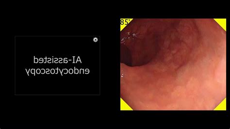 Simultaneous Detection And Characterization Of Diminutive Polyps With The Use Of Ai Youtube