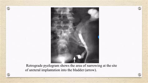 retrograde pyeloureterography pptx medical tests medical health