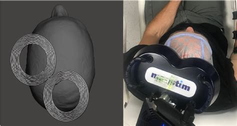 Coil Positioning Left The Simulated Coil Is Placed To Induce A Download Scientific Diagram