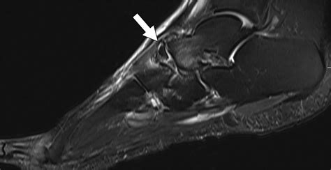 Imaging Of Mueller Weiss Syndrome A Review Of Clinical Presentations