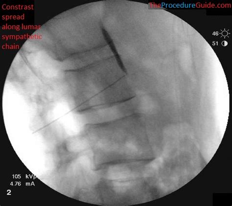 Fluoroscopic Guided Celiac Plexus Splanchnic Nerve Block Technique And Overview The