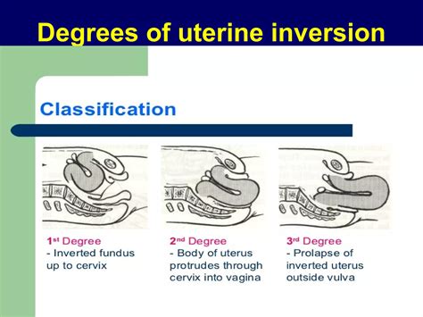 Retroverted Retroflexed Uterus Anduterine Inversion Ppt