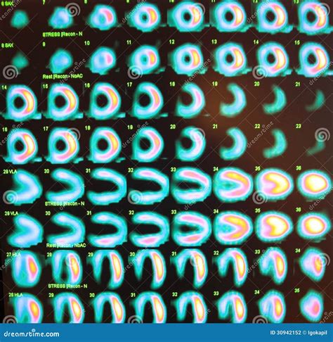 Moderate Myocardial Ischemia Image 46564714