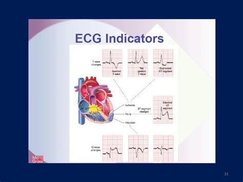 Ekg Myocardial Ischemia And Infarction Ppt