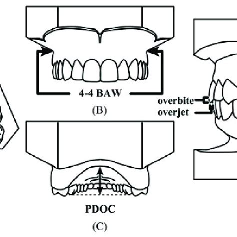 Odontometric Variables Used In The Dental Casts Analysis A Crown Download Scientific Diagram