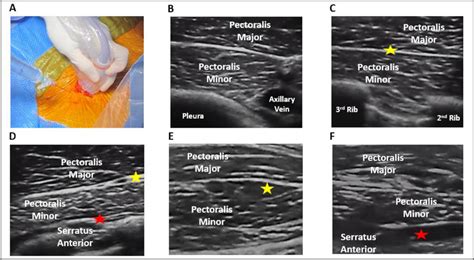 Intraoperative Pectoral Nerve Pecs Block At The Time Of Cardiac